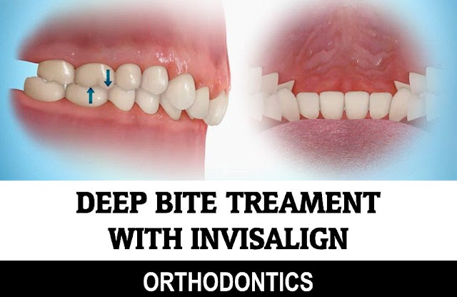 INVISALIGN: Deep Bite Treament - Dr. Brad Holmberg
