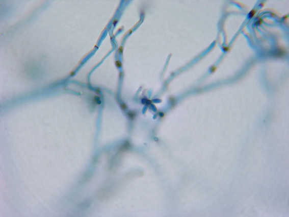 Fun With Microbiology (What's Buggin' You?): Fonsecaea pedrosoi/monophora