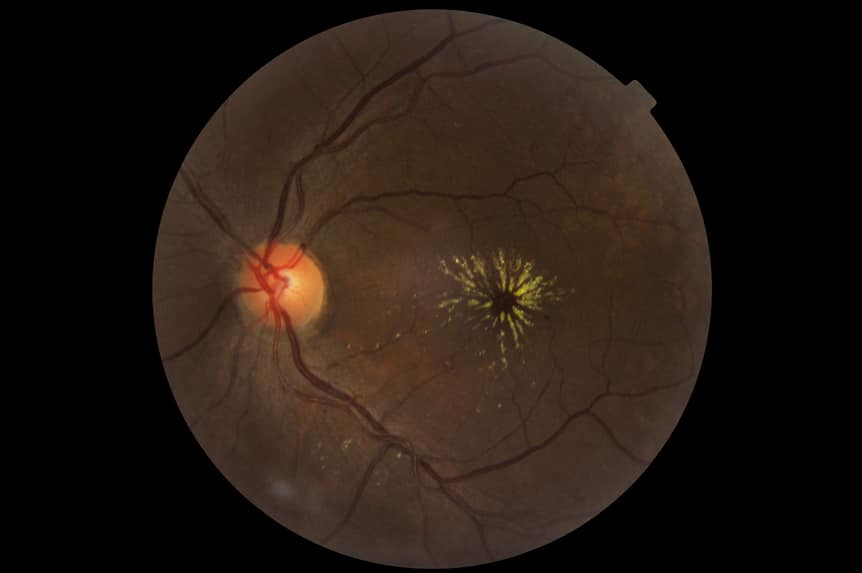 Ophthalmology Notes: ASTRONOMICAL NOMENCLATURE IN OPHTHALMOLOGY