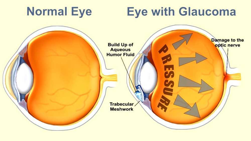 Glaucoma surgery