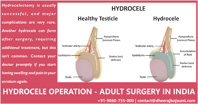 Hydrocele Surgery In India What You Need To Know