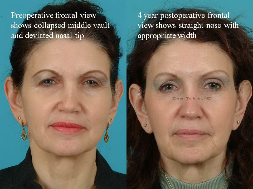 Dr. Dean Toriumi Reviews: Dean Toriumi Reviews: A collapsed nose due to ...