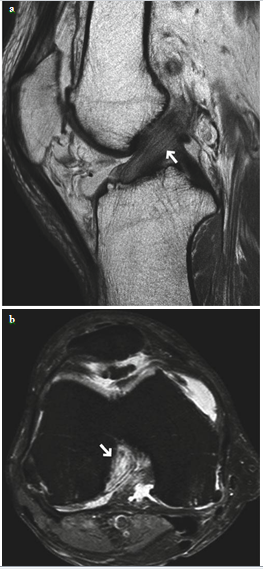 MRI Dây Chằng Chéo Trước (ACL)
