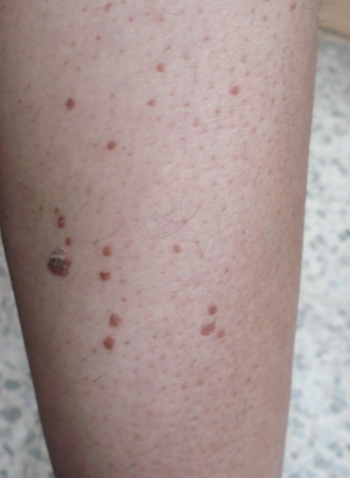 Photos of Moles on Hand Arm and Leg ~ How To Remove Moles, Warts, Skin ...