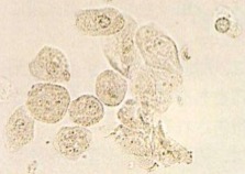 kimia klinik: Pemeriksaan sedimen urine