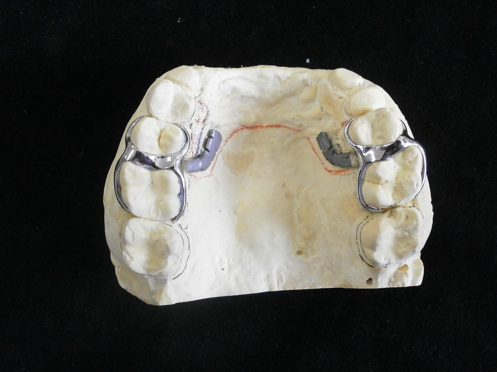 髙田朝（Hajime Takada）のオーダーメイド歯科技工物の紹介 Introduction of custom-made dental ...