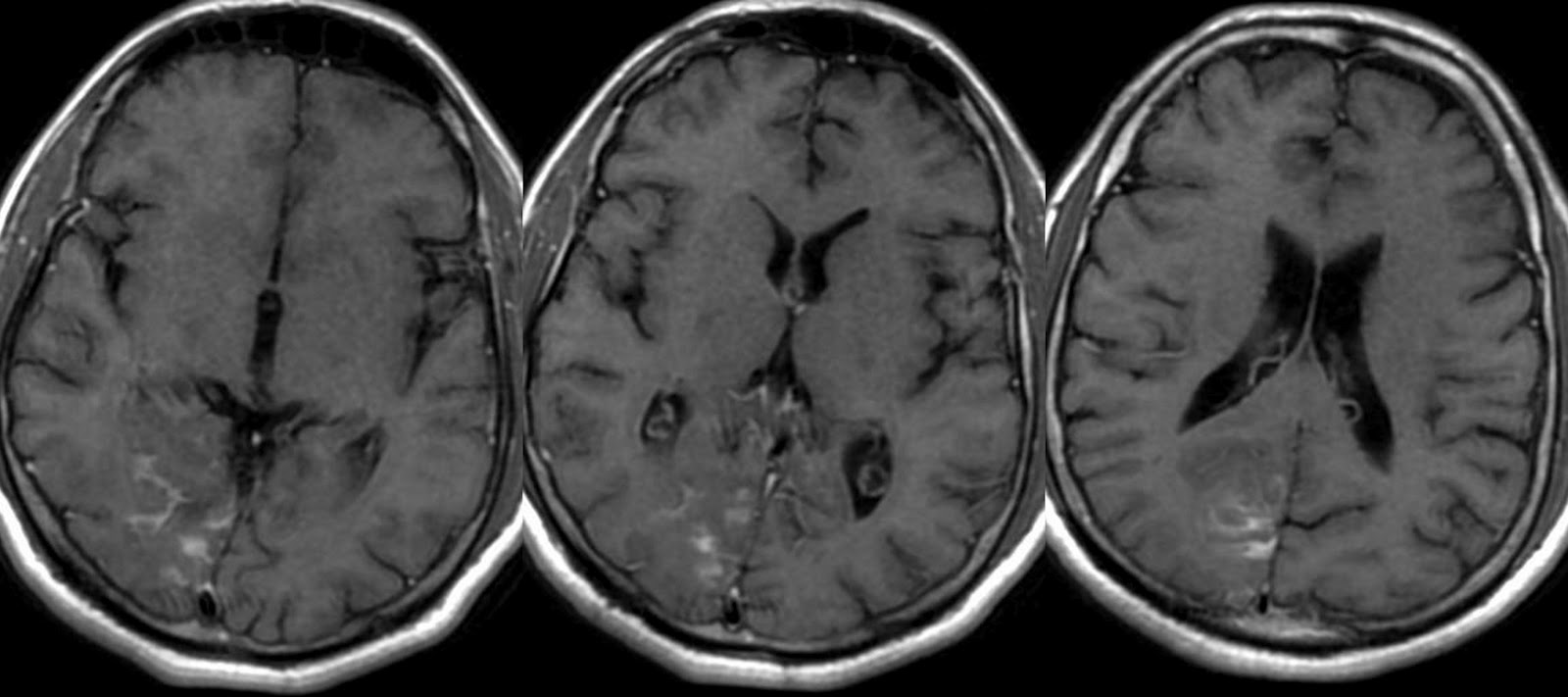 Dr Balaji Anvekar FRCR: Gyriform enhancement