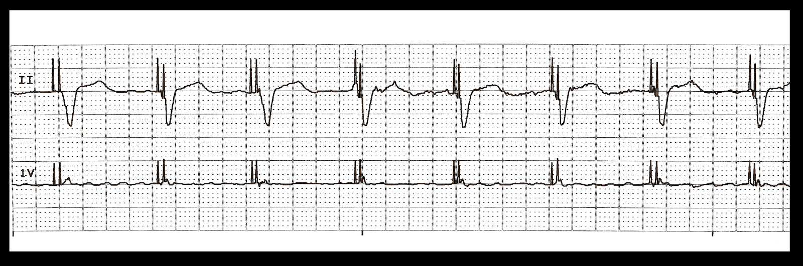 Basic EKG Rhythm Test 23