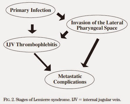 Tangents: Lemierre Syndrome