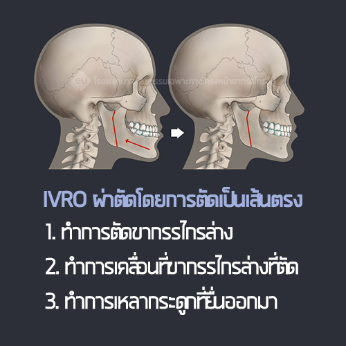 โรงพยาบาลอียู EU Surgery: วิธีผ่าตัด SSRO และ IVRO