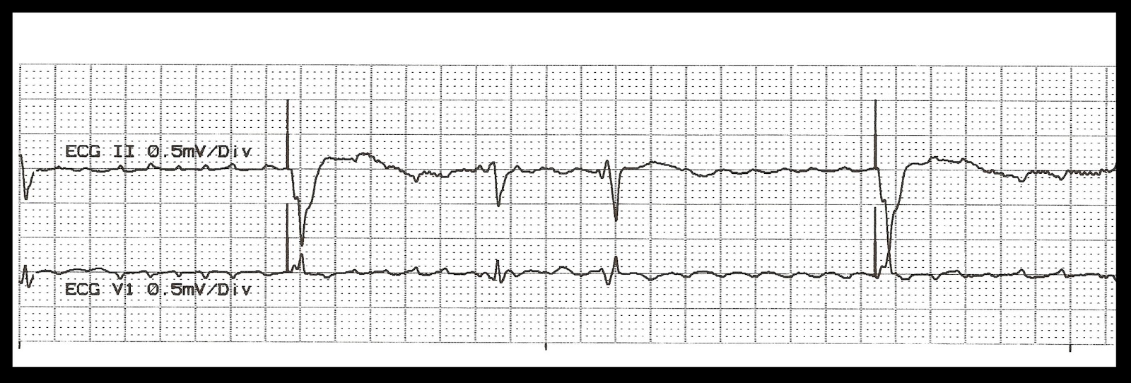 EKG Rhythm Strips 23: Paced Rhythms