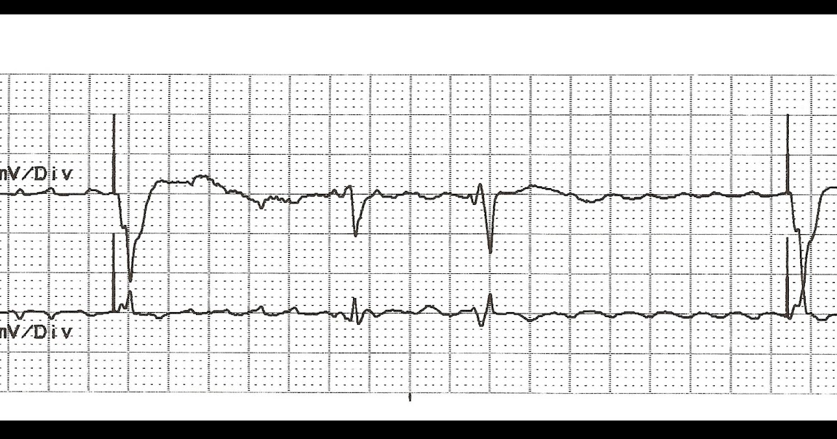 Float Nurse: EKG Rhythm Strips 23: Paced Rhythms