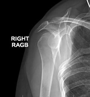 Shoulder and Elbow Surgery: Sprengel Deformity in adulthood