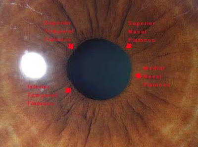 Modern & Multidimensional Iridology: Pupil Applanations, Schwalbe's ...