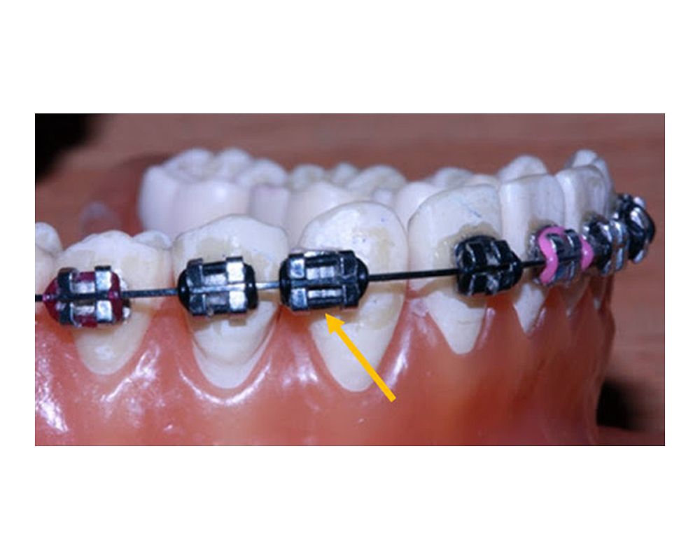 ¿Qué puedes hacer si se te cae un bracket? - OdontoVida