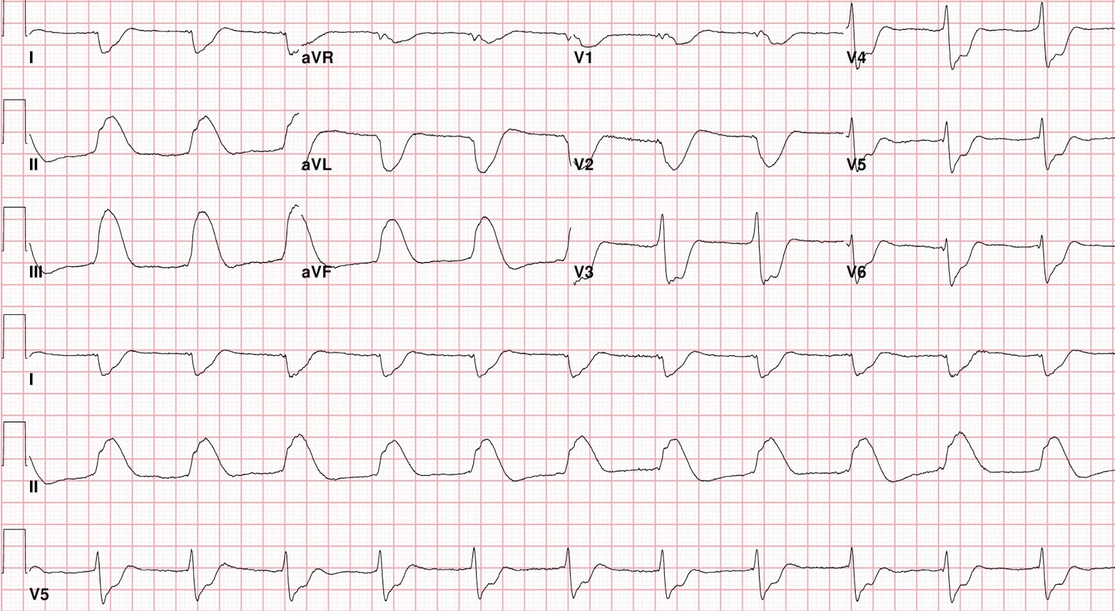 overview for LBBB1