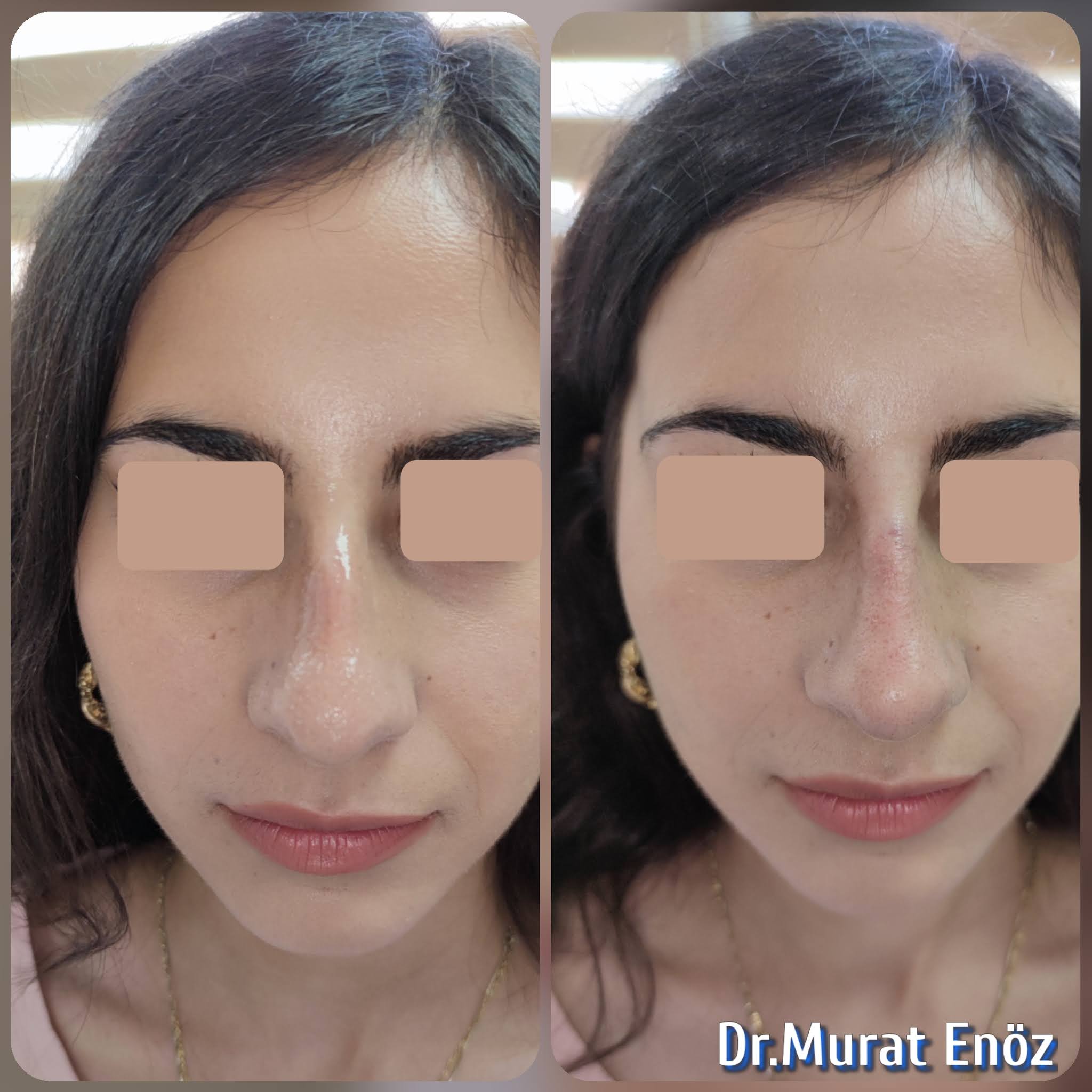 Liquid Rhinoplasty With Limited Filler Injection