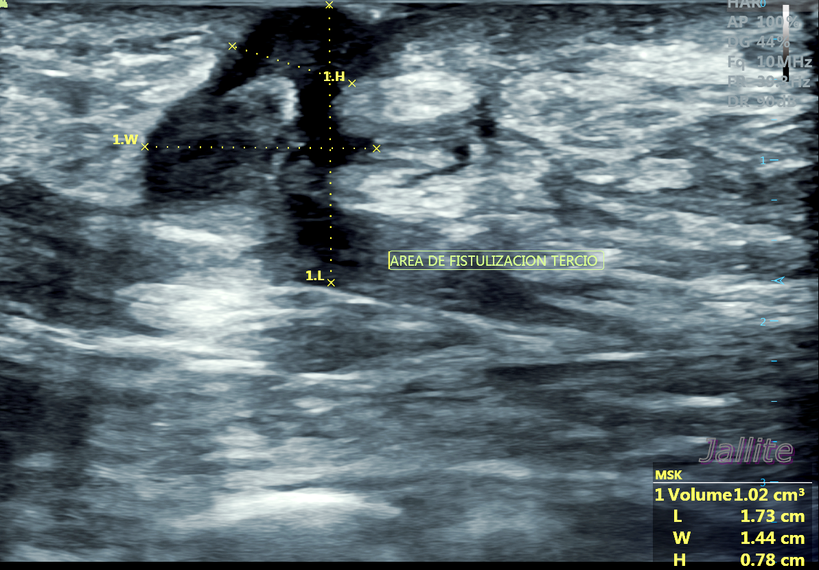 Abscesos Pared Abdominal con Cuerpos Extraños