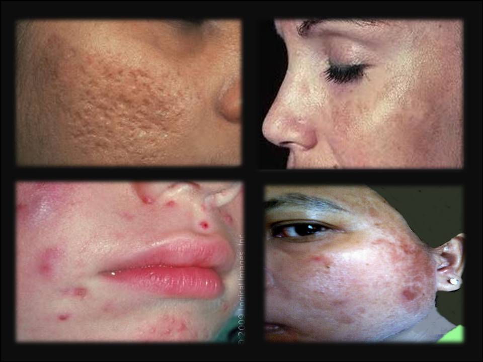 CARA TANGANI MASALAH KULIT MUKA YANG SEMAKIN TERUK | Kotak Vitamin Saya
