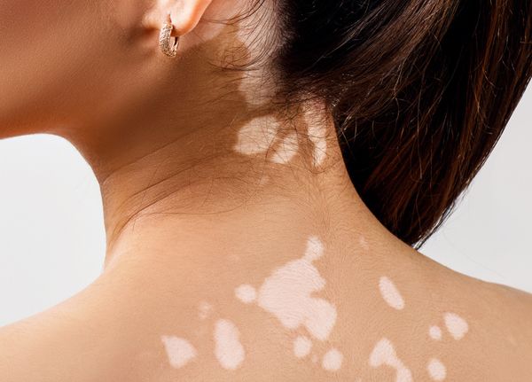 Causes Of White Spots On Face And Skin