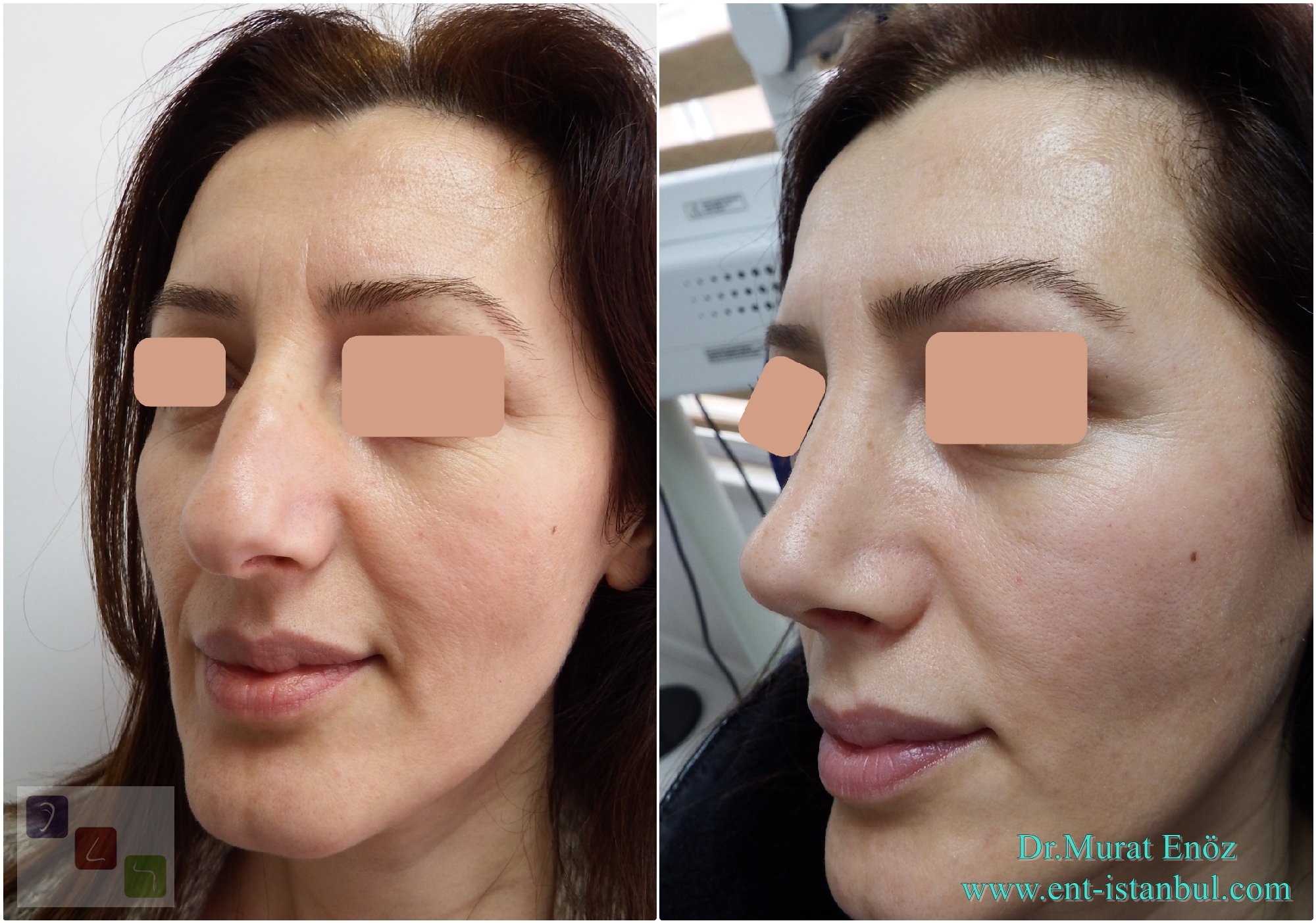 Health Zone Turkey: Nose Job in Istanbul, Turkey