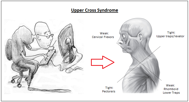 Rise Sports Therapy: Upper Cross Syndrome.... It's in Your Posture