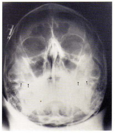 PARIETOACANTIAL (METODO DE WATERS)