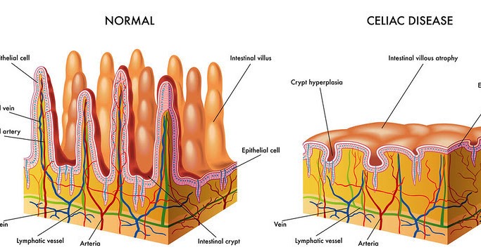 Symptoms of Celiac Disease: Symptoms of Celiac Disease