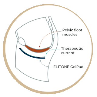 Regain Control Over Incontinence with ELITONE