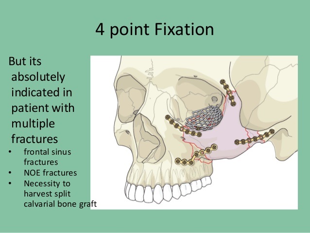 Zygomaticomaxillary Fracture Treatment | Surgery | Symptoms