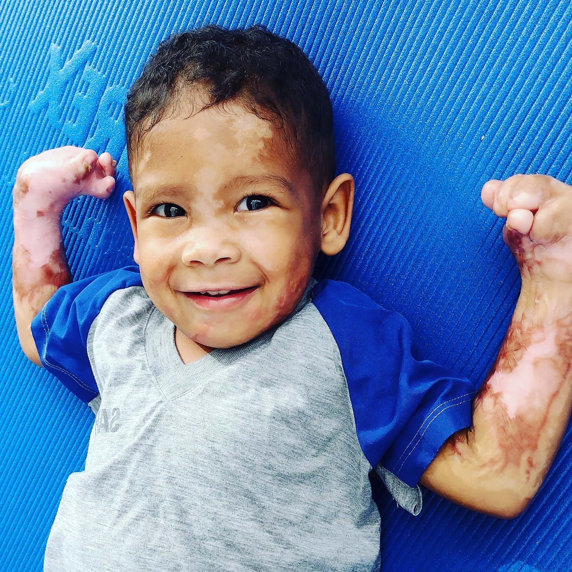 Blog do Gilberto Lima: Família de menino com sequelas de queimaduras ...