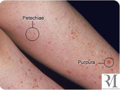 Fisioterapia em Pós Operatório de Cirurgias Plásticas: Hematoma ou ...