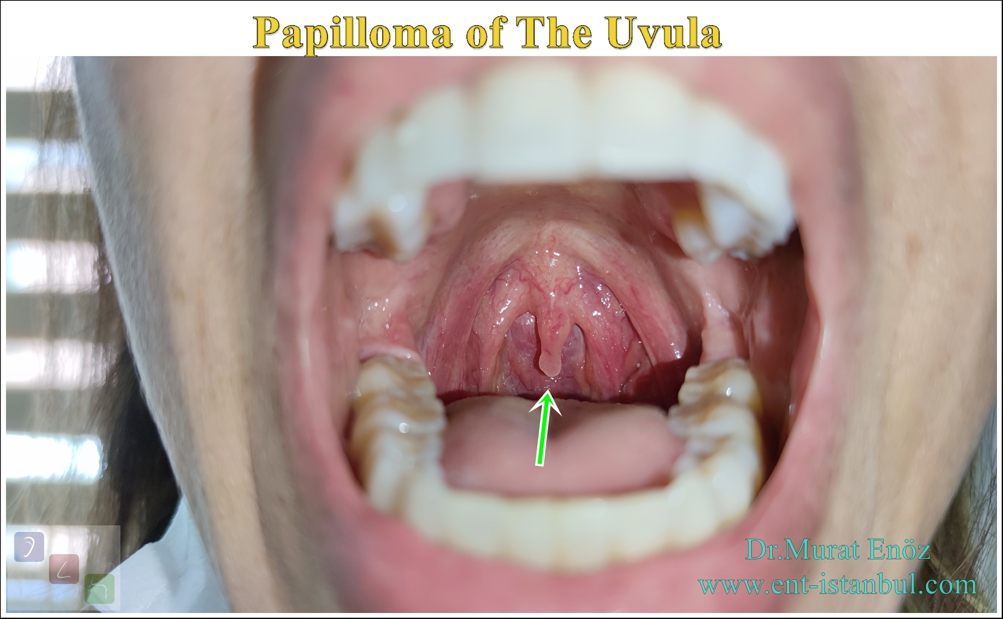 Uvula Papilloma Cause Frank Worthley Marinaio Parana River Papilloma