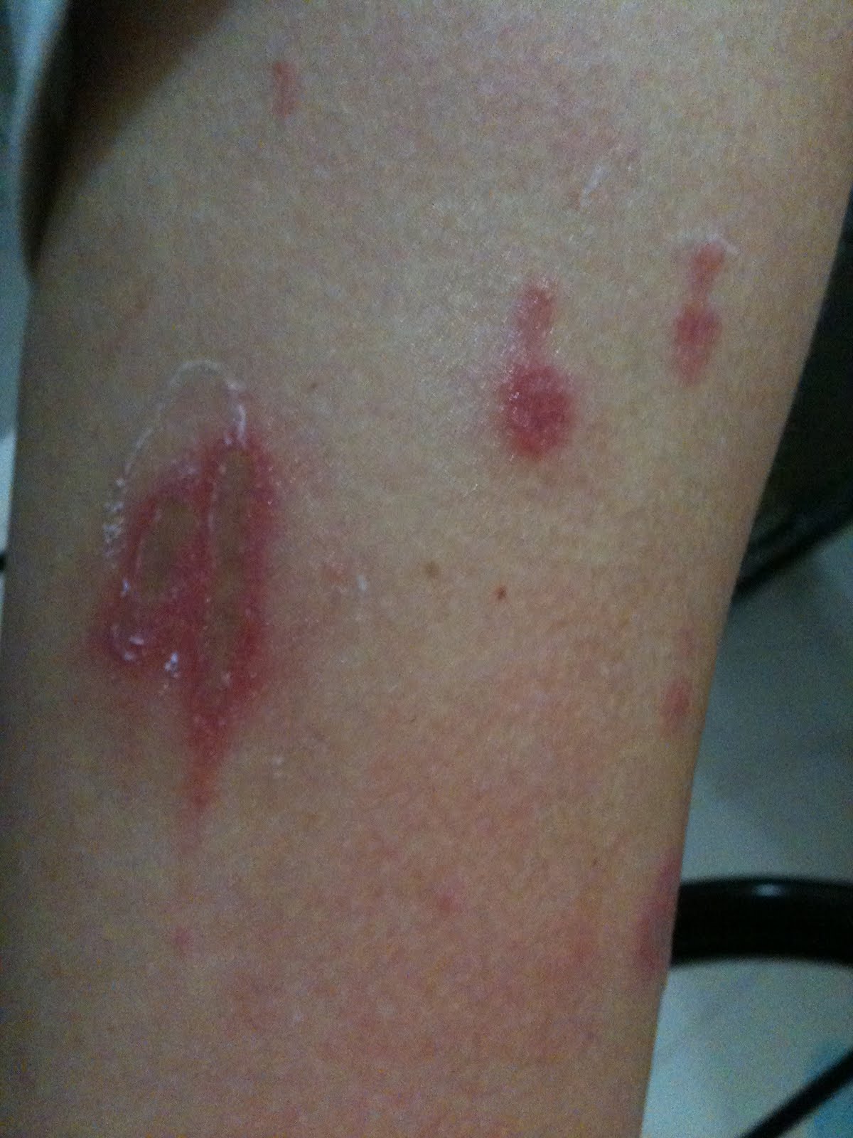 .Melissa's: Charlie / Penyakit Kulit Kumbang Rove