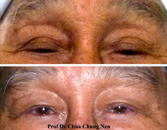 Eyelid Surgery by Prof Dr CN CHUA 蔡鐘能: Droopy Eyelids: More than Excess ...