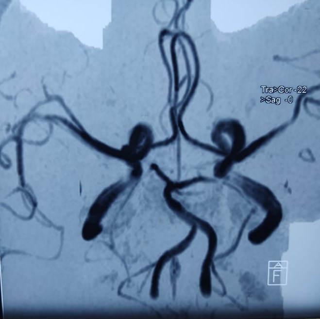 Wernicke's Aphasia : MRI - Sumer's Radiology Blog