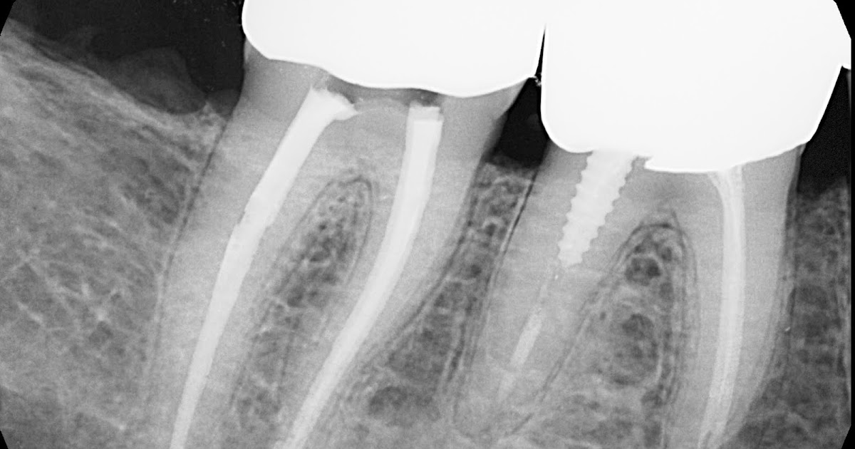 The Endo Blog: Value and Limitations of CBCT in Endodontics-Case Report