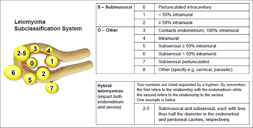 " AYAT ' Blog": Apa itu Embolisasi Fibroid Uterine(Mioma uteri)?