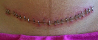 mama Batrisyia: Tips Jaga Luka Pembedahan (Czer)