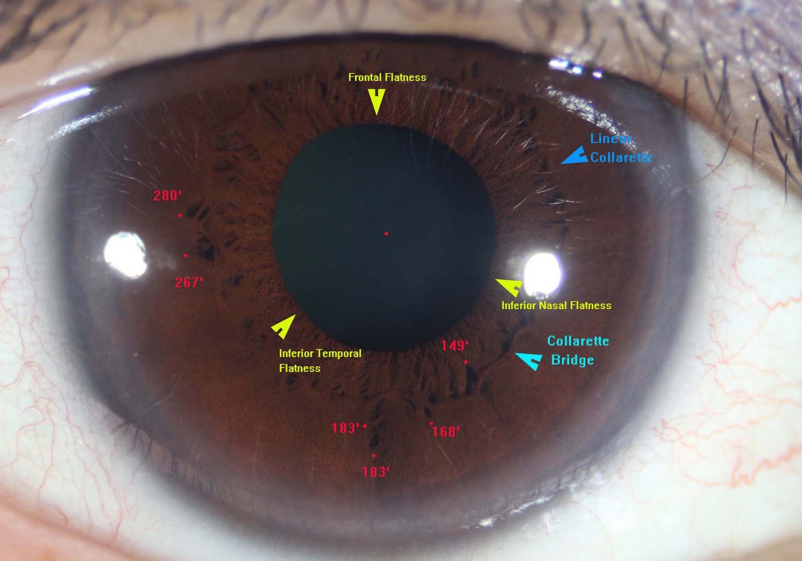 Modern & Multidimensional Iridology: Pupil Flattenings, Linear ...
