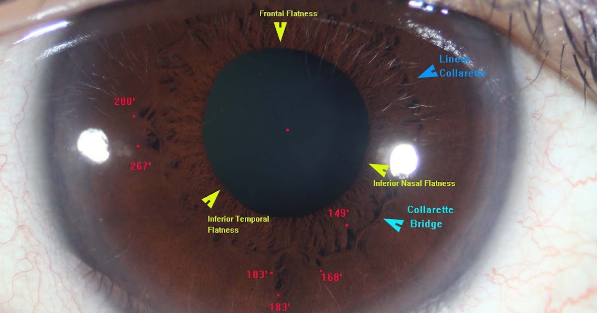 Modern & Multidimensional Iridology: Pupil Flattenings, Linear ...