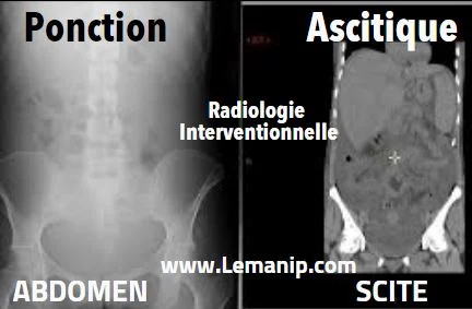Ponction Ascitique Radiologie Interventionnelle