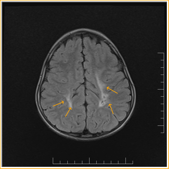 Periventricular leukomalacia: MRI - Sumer's Radiology Blog