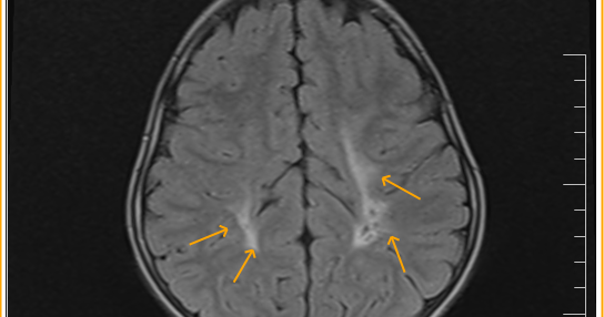 Periventricular leukomalacia: MRI - Sumer's Radiology Blog