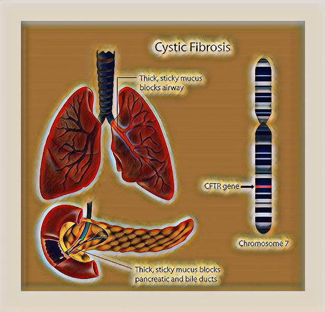 Apa itu fibrosis kistik? Apa saja gejala fibrosis kistik? - DWI PURWANTO