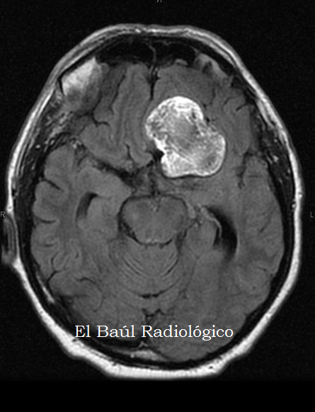 El Baúl Radiológico: 2) QUISTE DERMOIDE INTRACRANEAL (Intracranial ...