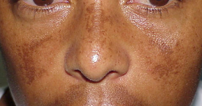 Best Skin Lightening To Eliminate Hyperpigmentation or Melasma: How to ...