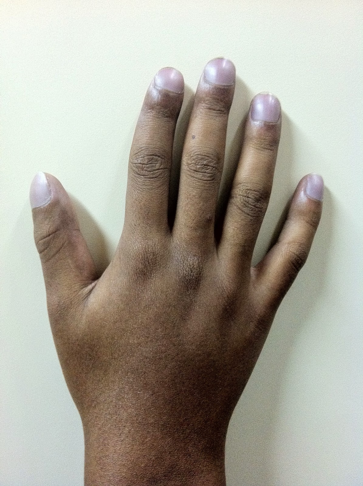 Discusión de Casos Clínicos : Imágenes Médicas: Inspección de las manos