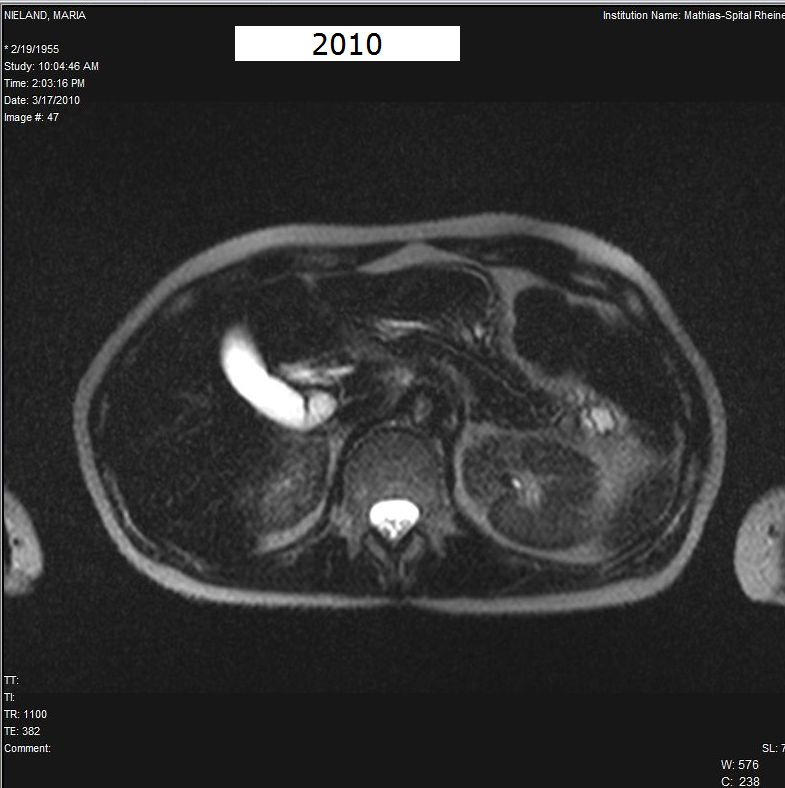hourglass gallbladder