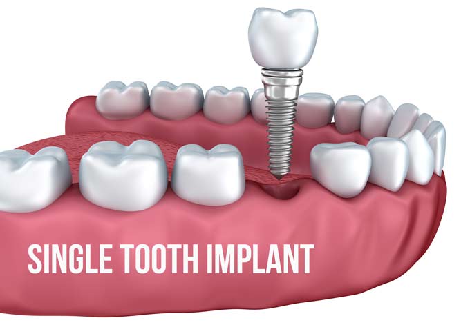 delhidentist: What are dental implants and how do they work?